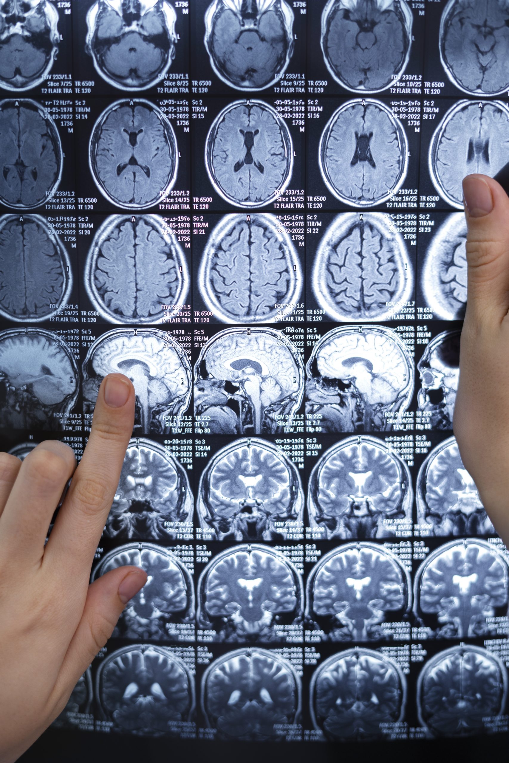 La signification des taches blanches - Département de psychiatrie et d ...